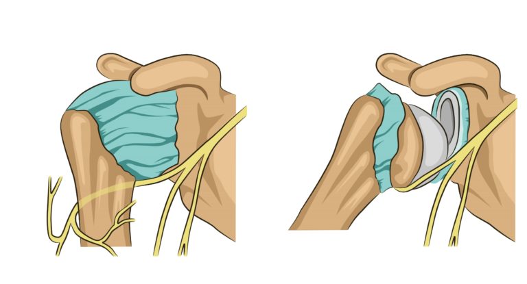Nerve Injuries | Auckland Shoulder Clinic | Physio Treatment