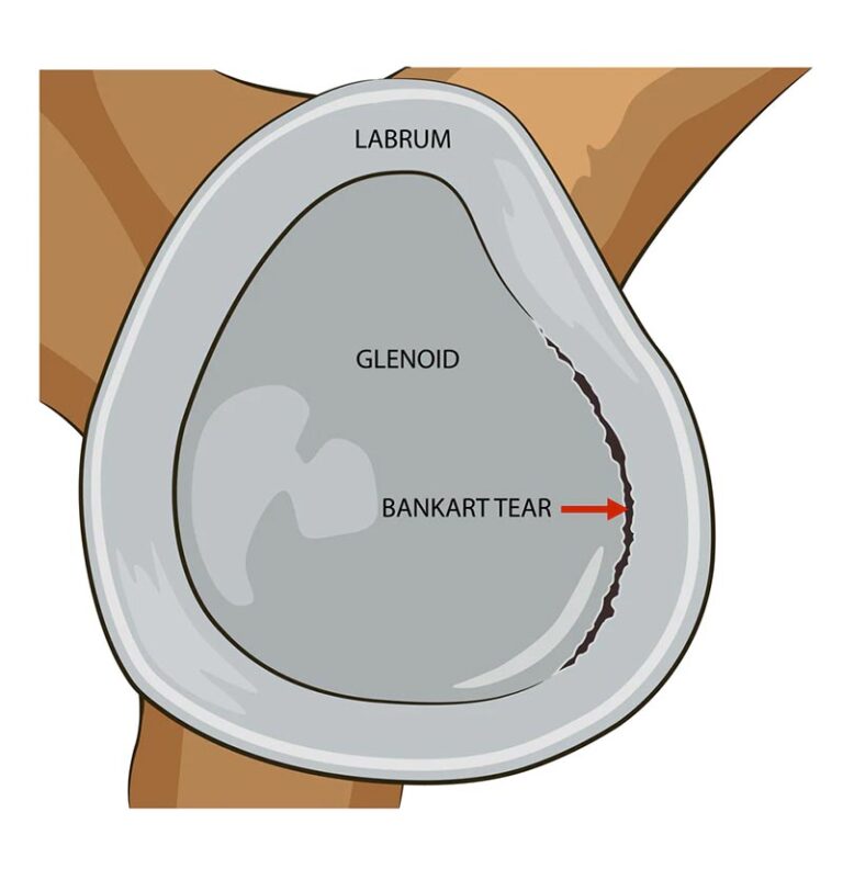 Shoulder Dislocation Pathology | Auckland Shoulder Clinic