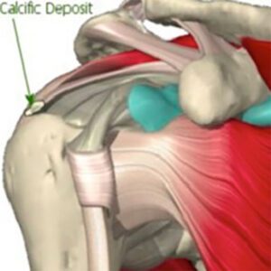 Calcific Tendinitis | Auckland Shoulder Clinic | Physiotherapy